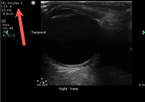 Ultrasound of the Month: Ocular Abscess — Taming the SRU