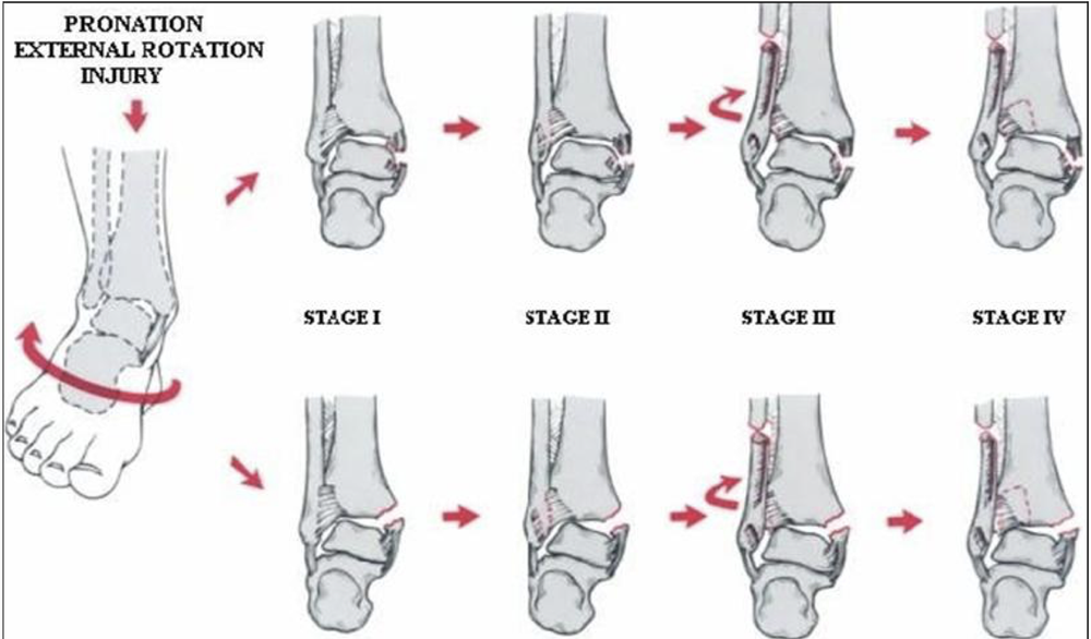 Twists and Turns: Identifying Maisonneuve Fractures in the ED — Taming ...