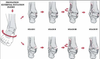 Twists and Turns: Identifying Maisonneuve Fractures in the ED — Taming ...
