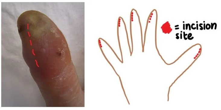 Mastering Minor Care: Paronychia and Felon — Taming the SRU