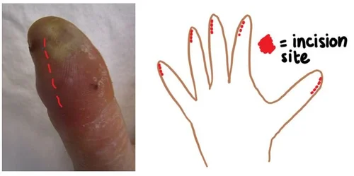 Mastering Minor Care: Paronychia and Felon — Taming the SRU