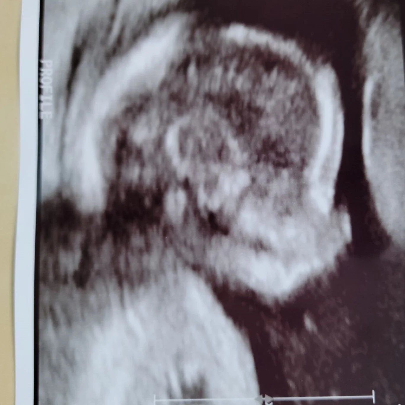 Anatomy Scan — Life With EFG