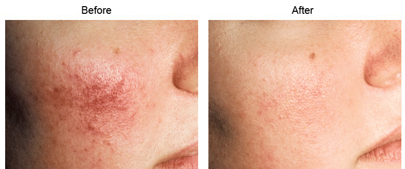 How Long Does It Take To See Results From Vbeam - The Best Picture Of Beam