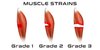 Muscle Strain Grading: Traditional Grading versus Modern Approach ...