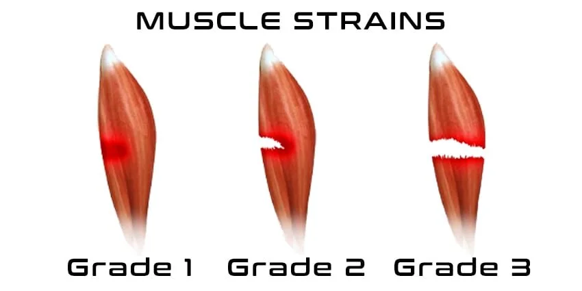 Muscle Strain Grading: Traditional Grading versus Modern Approach ...