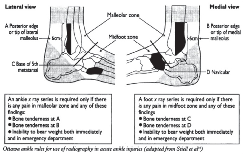 The Ottawa Ankle and Knee Rules — Thornleigh Performance Physiotherapy