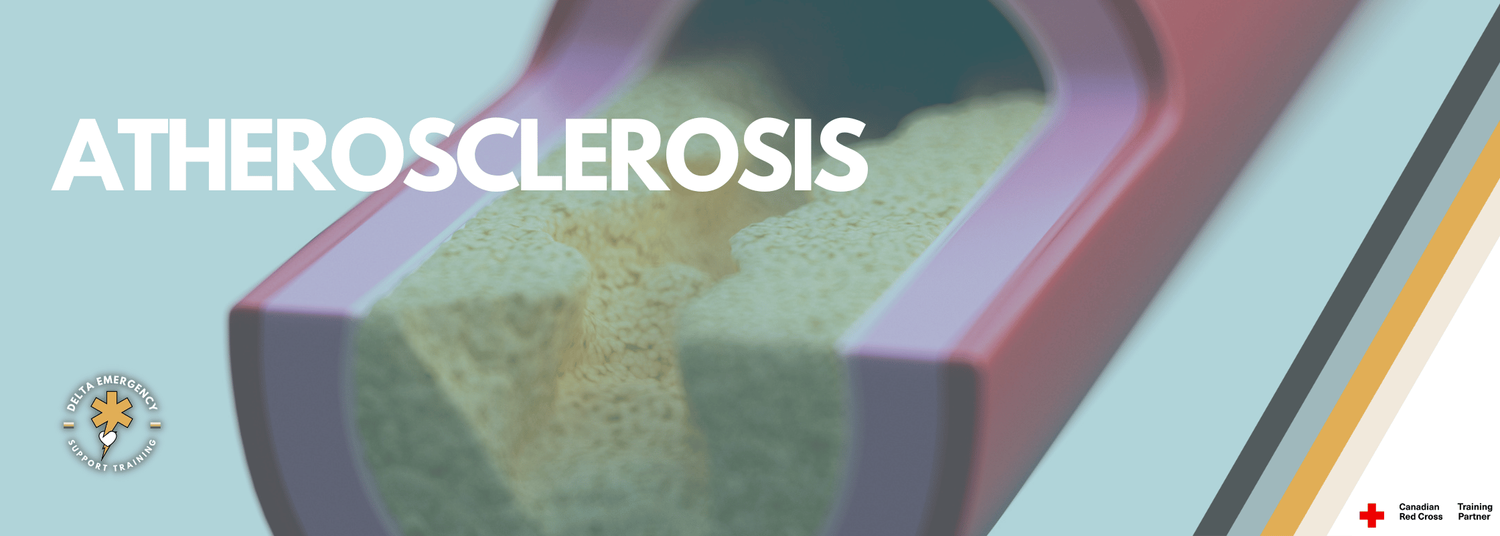 Atherosclerosis: Symptoms, Dangers, and Strategies for Prevention and ...