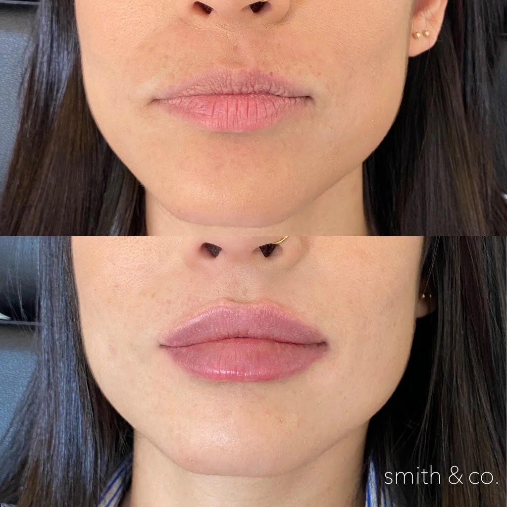 Half or Full Syringe? When It Comes to Lips, Which is Best? — danielle ...
