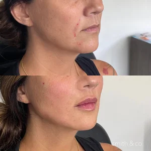jawline contour — Miami Beach Botox Specialist