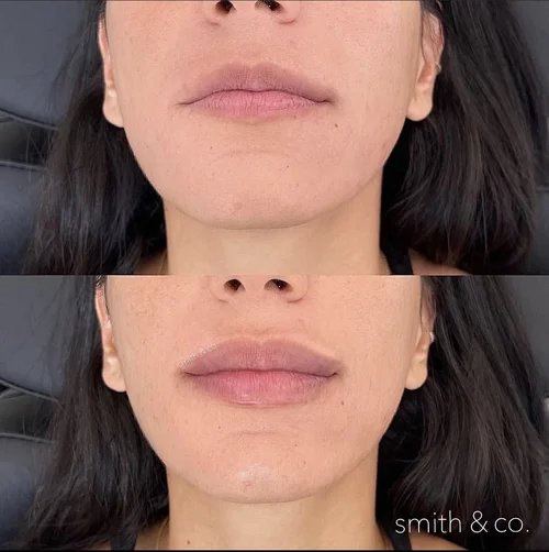 if i were a vial of botox... — Miami Beach Botox Specialist