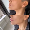 jawline contour — Miami Beach Botox Specialist