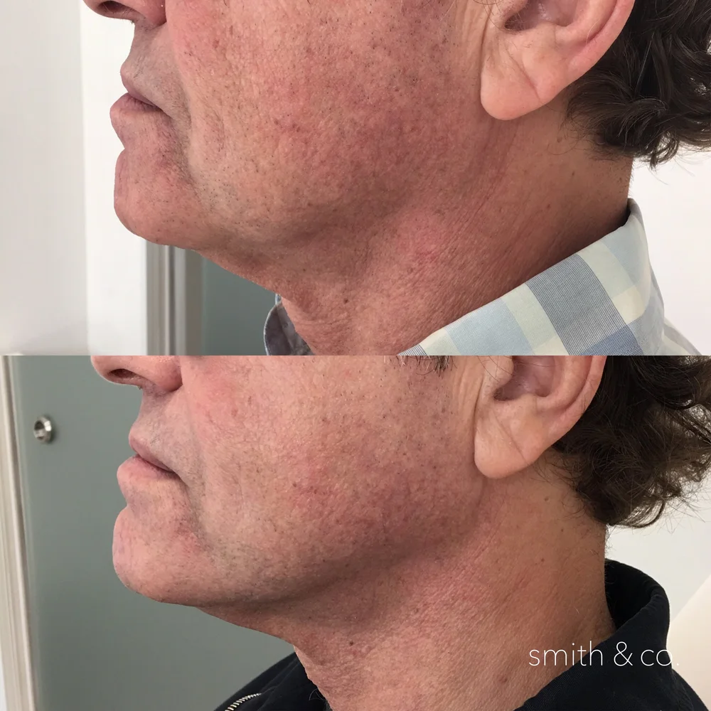 jawline contour — Miami Beach Botox Specialist