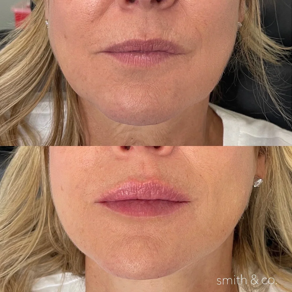 lips — Miami Beach Botox Specialist