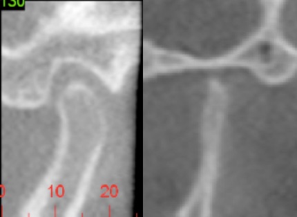 Condylar Resorption — Arnett | Gunson