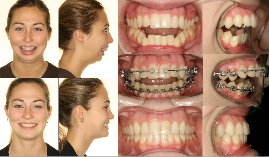 Condylar Resorption — SBFR | Gunson