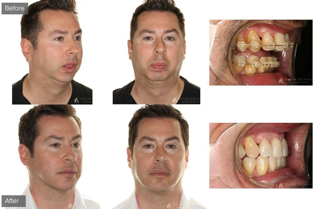 Arnett Gunson Before and After Images - Faces — SBFR | Gunson