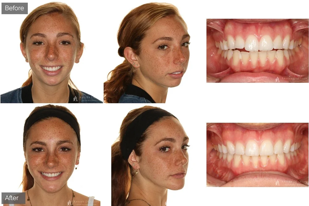 Arnett Gunson Before and After Images - Faces — SBFR | Gunson