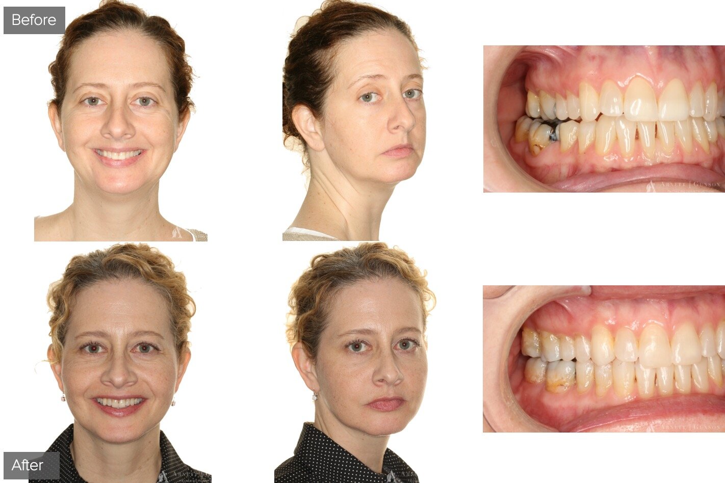 Arnett Gunson Before and After Images - Faces — SBFR | Gunson