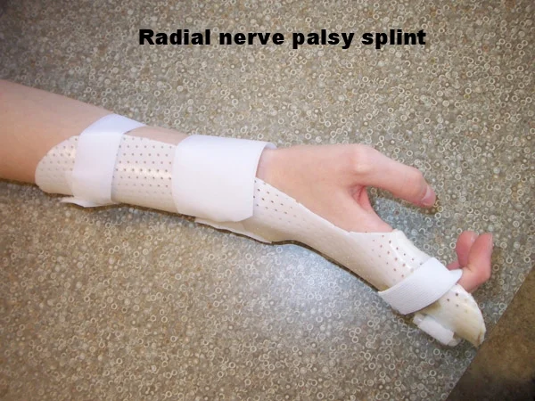 Radial Gutter Hand Splints