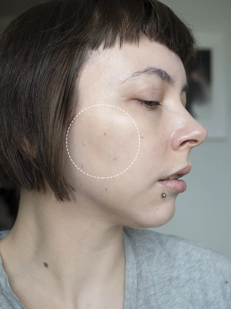 Dermapen4 Treatment by Rebel Helsinki (Review) — Laura Loukola