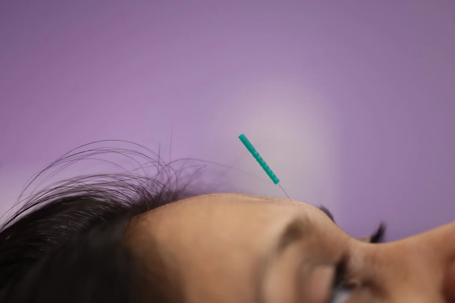 Facial Rejuvenation Acupuncture in Moorestown, NJ | AcuPharm Health ...