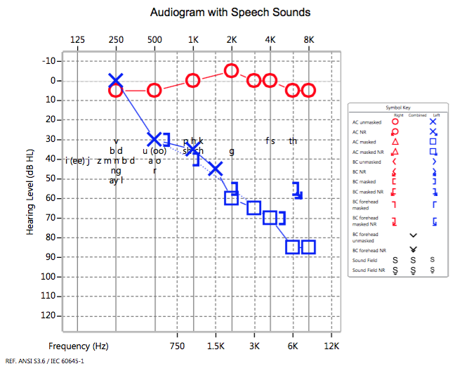 Normal Audiogram