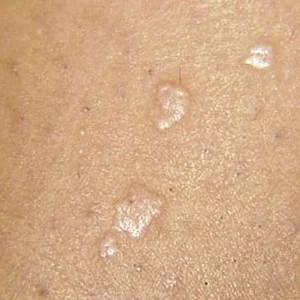 How to distinguish flat warts from other similar looking skin ...