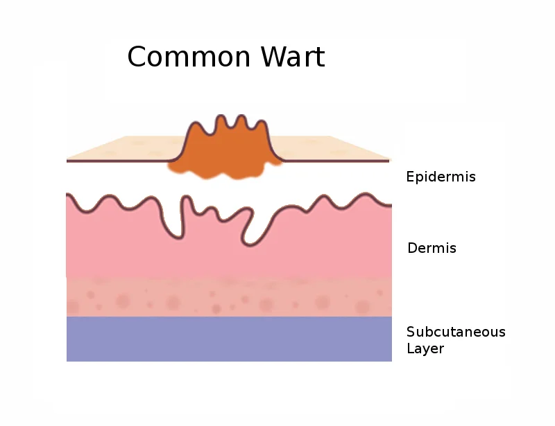 Side view diagrams of the most common forms of warts. — MOYAL THERAPIES