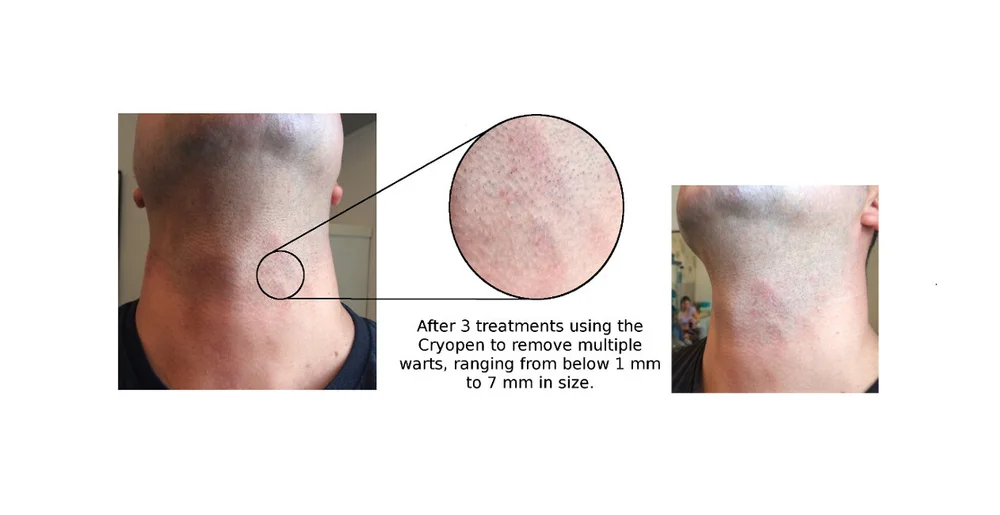 Wart Removal Information — MOYAL THERAPIES