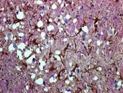 Infection by Protein: The Prion Theory of Disease — Journal of Young ...