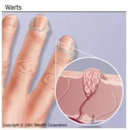 A New Medical Breakthrough: Wart to do when Verruca vulgaris Attacks ...