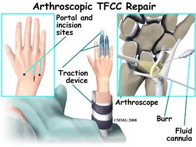Triangular Ligament Wrist
