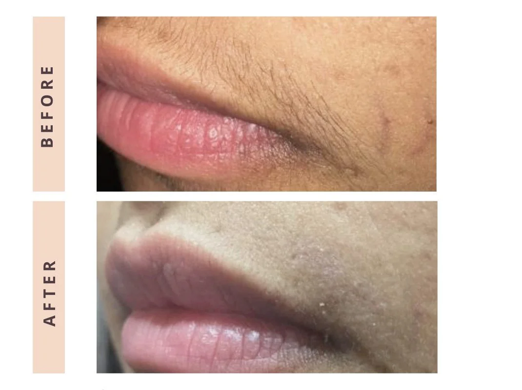 Hair Removal by Laser | Beauty Bar by Heather, New Bern NC | Beauty Bar ...