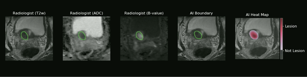 Ezra Delivers Full-body MRI Cancer Screening that Saves Lives — LDV Capital