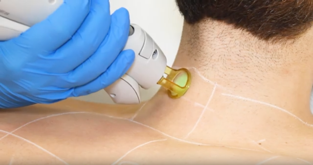 Why Are More Men Getting Laser Hair Removal? — MEN'S STYLE BLOG