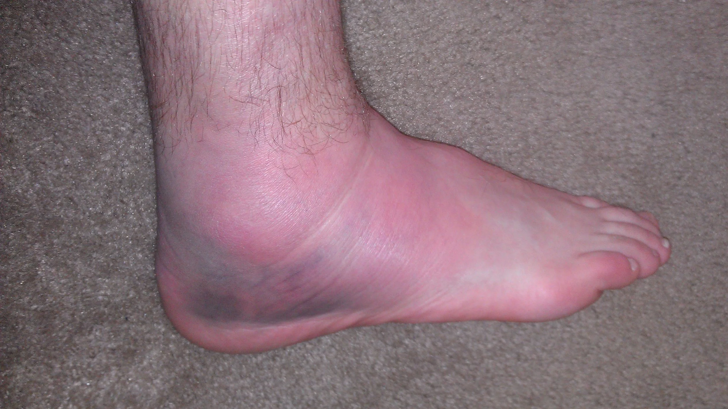 Ankle Pain Be Gone Revo Physiotherapy Sports Performance