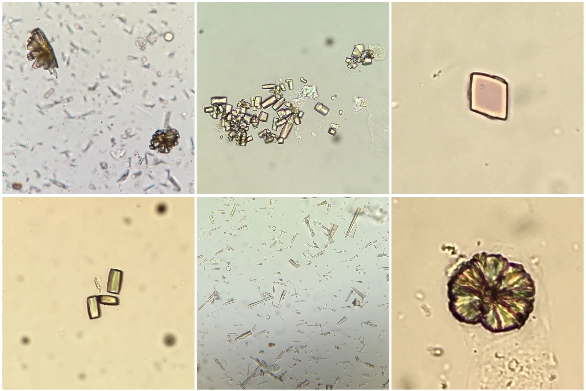 Identifying Crystals In The Urinary Sediment swissnephro