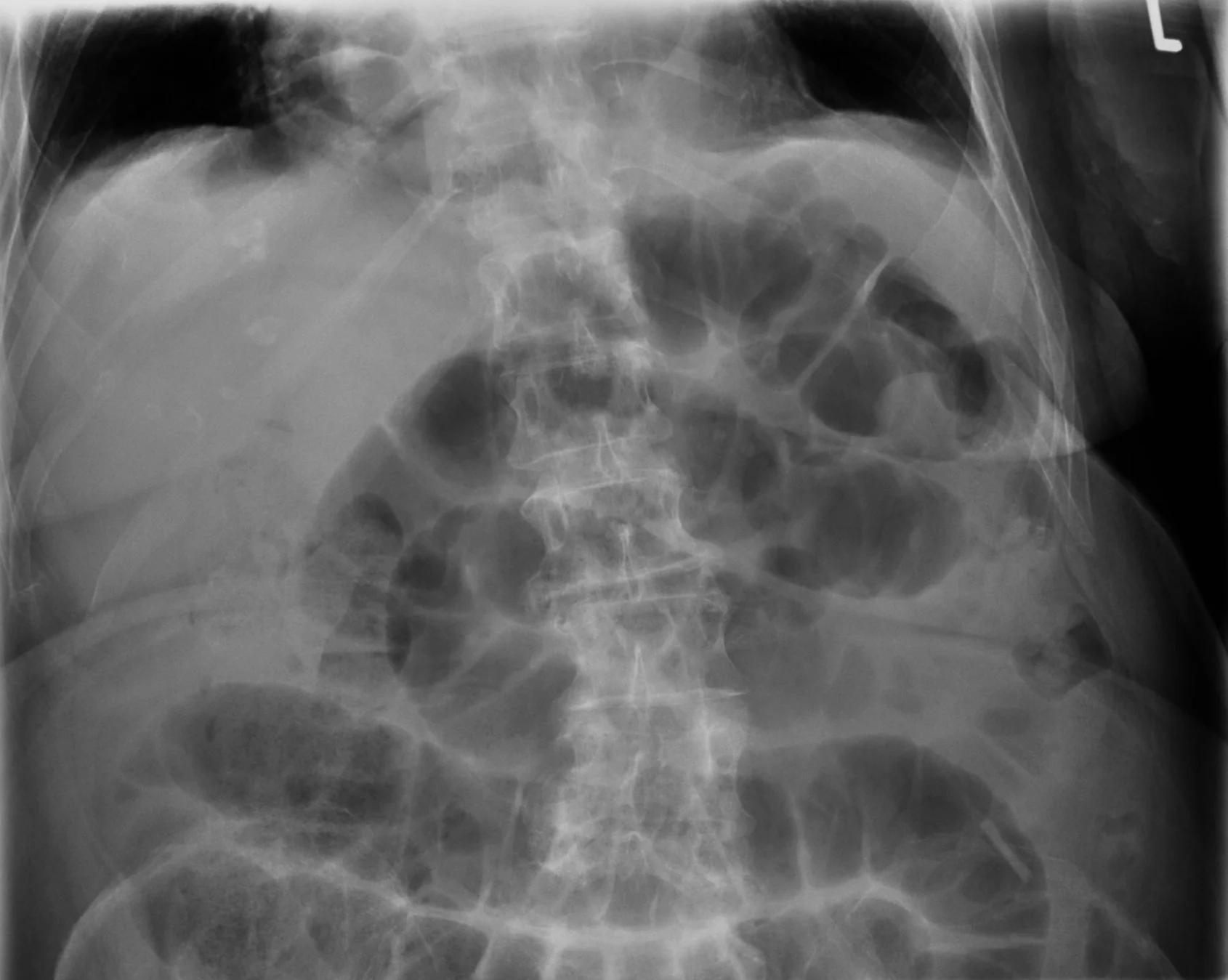 #MiniTeach: Another Surgical Abdomen — EM3