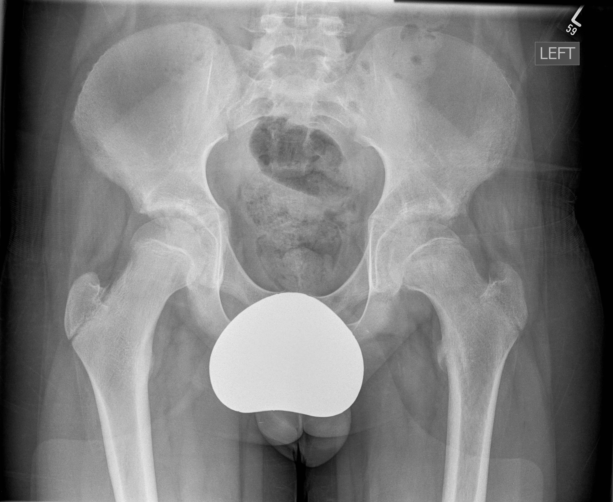 #MiniTeach: A Limping Teenager — EM3