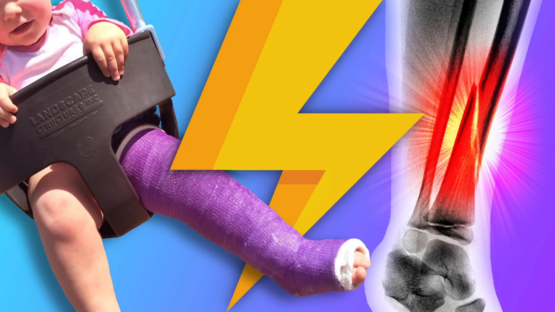 Lightning Learning: Toddler's Fracture — EM3