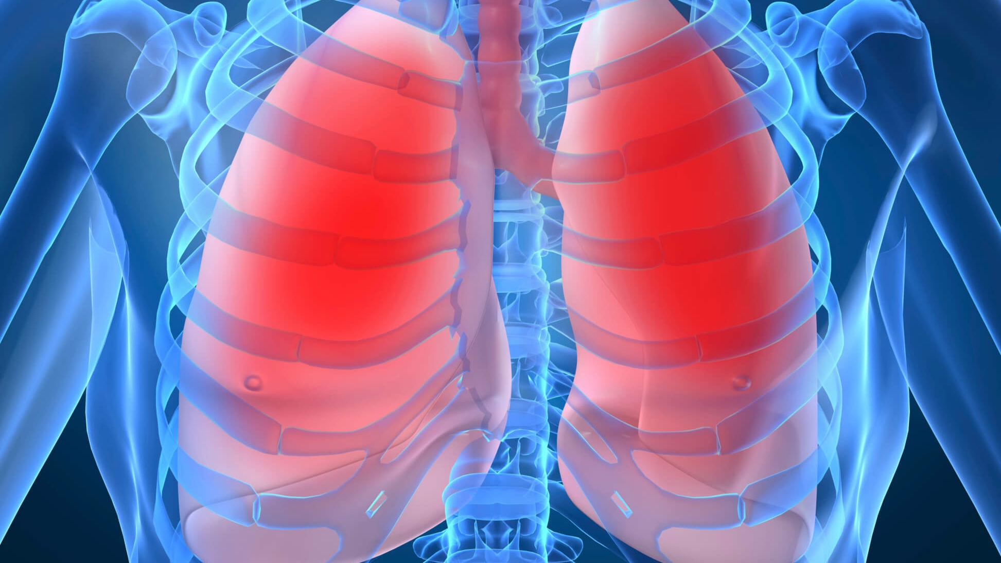 #SimBlog: Pneumonia, Secondary to Sepsis — #EM3: East Midlands ...