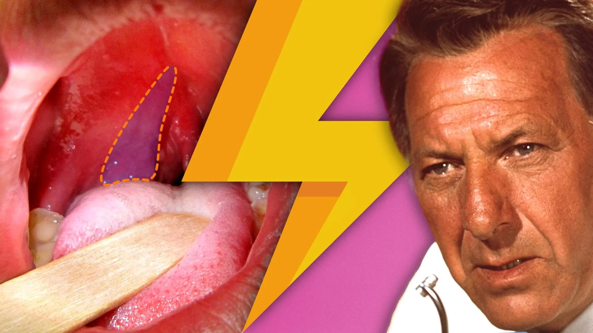 Lightning Learning: Peritonsillar Abscess — EM3