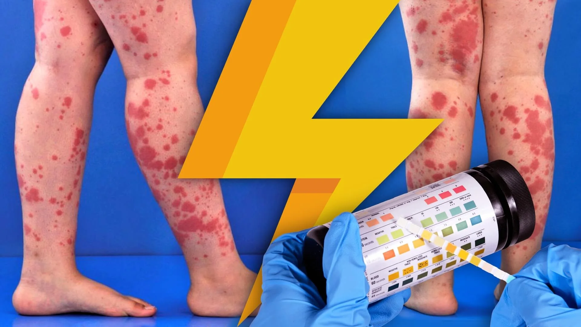 Henoch Schonlein Purpura In Adults