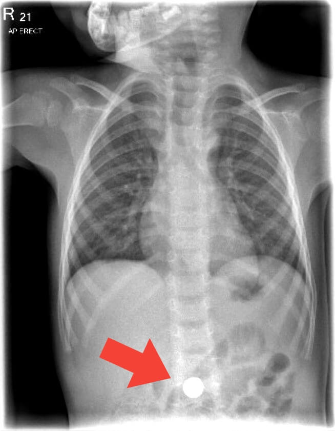 #MiniTeach: A Dangerous Tummy Button — EM3