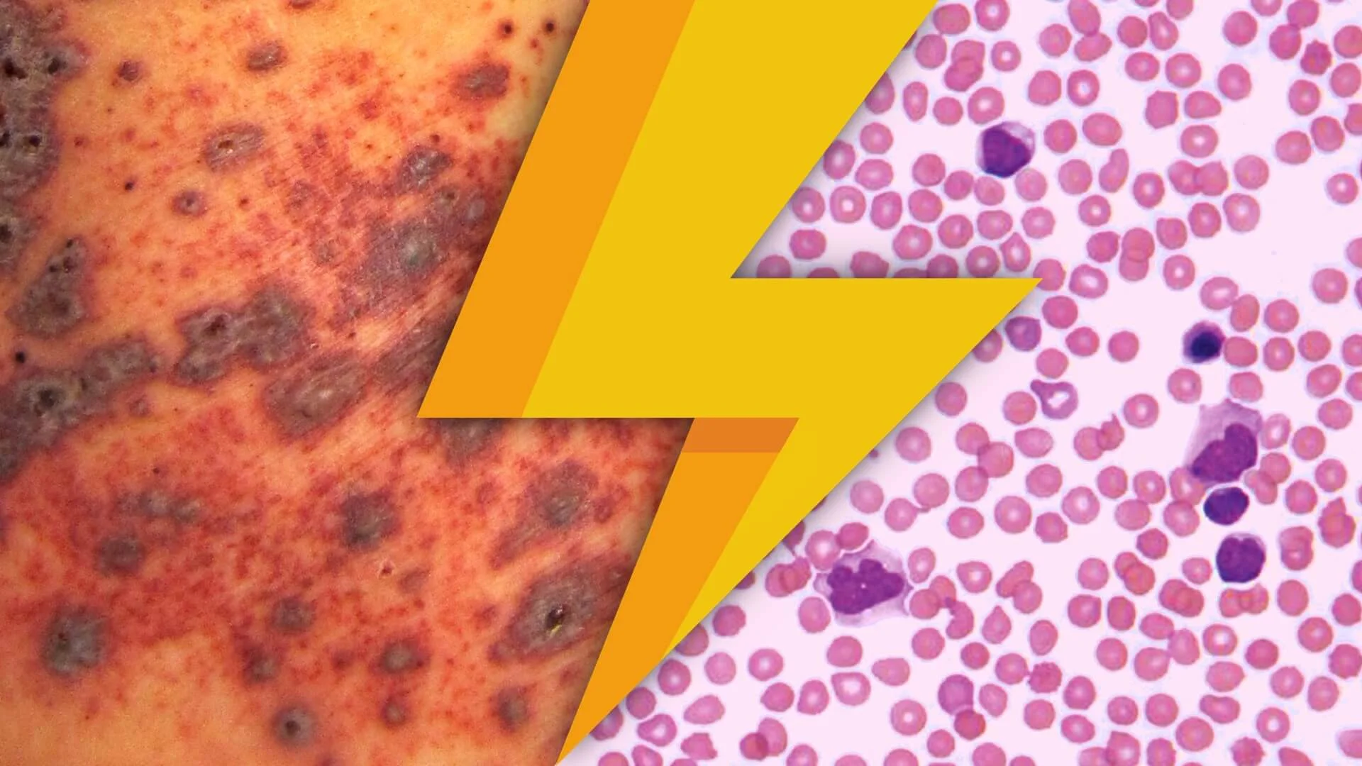 Lightning Learning: Immune Thrombocytopenia (ITP) — EM3
