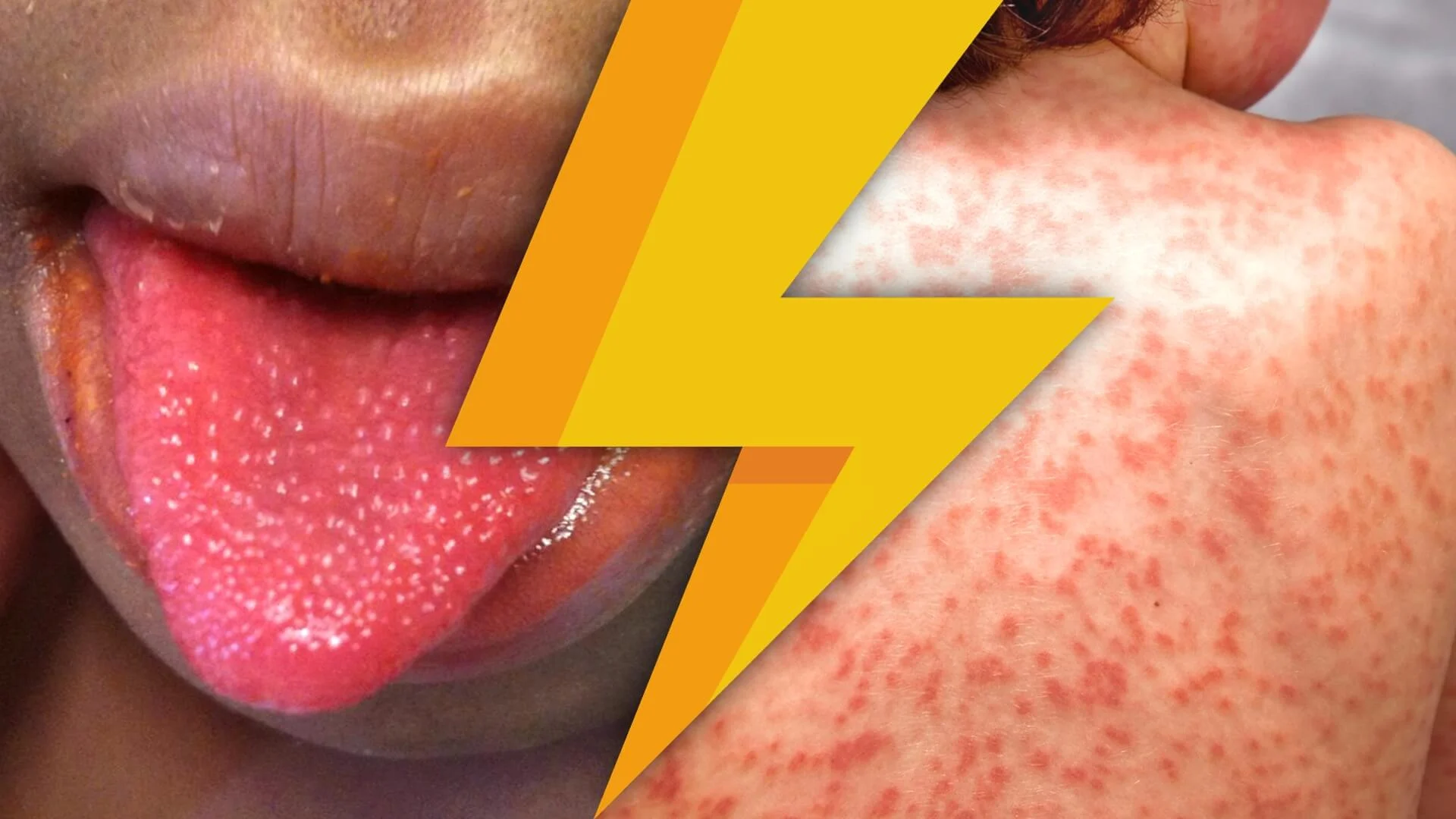 Lightning Learning: Infective Endocarditis — EM3