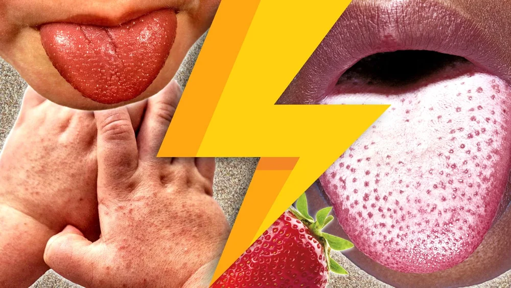 Scarlet Fever Scarlet Fever | DermNet NZ