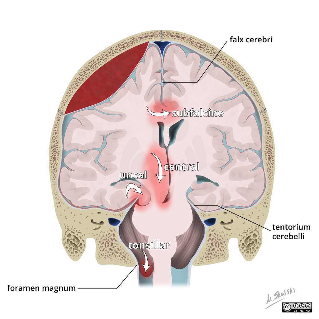 The Spectrum of Head Injuries — EM3
