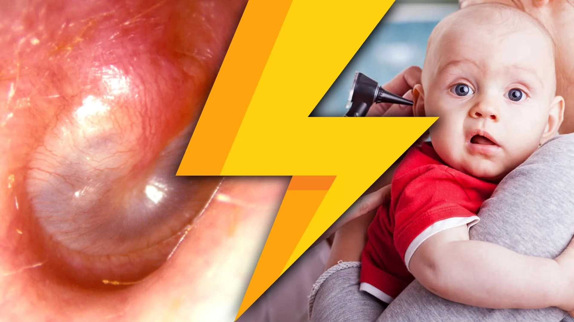 Lightning Learning: Otitis Media (Diagnosis & Management) — EM3