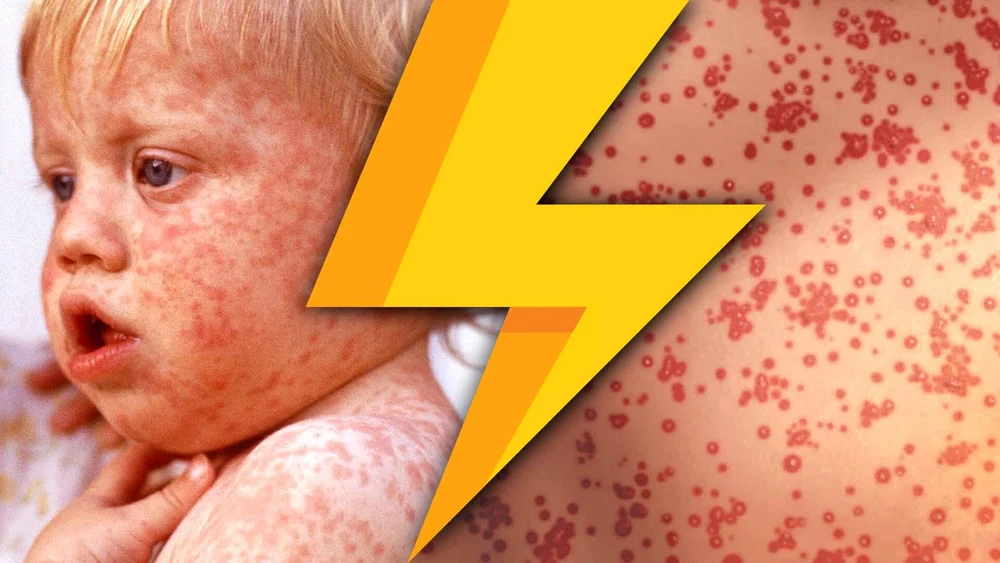 Measles Rash
